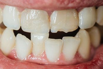What Causes Crooked Teeth? The Root of Misalignment